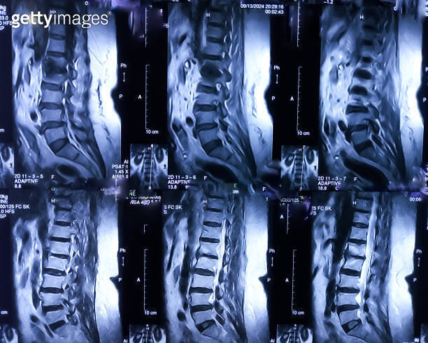 MRI of lamberspine: History case TB SPINE ,Infective spondylodiscitis ...