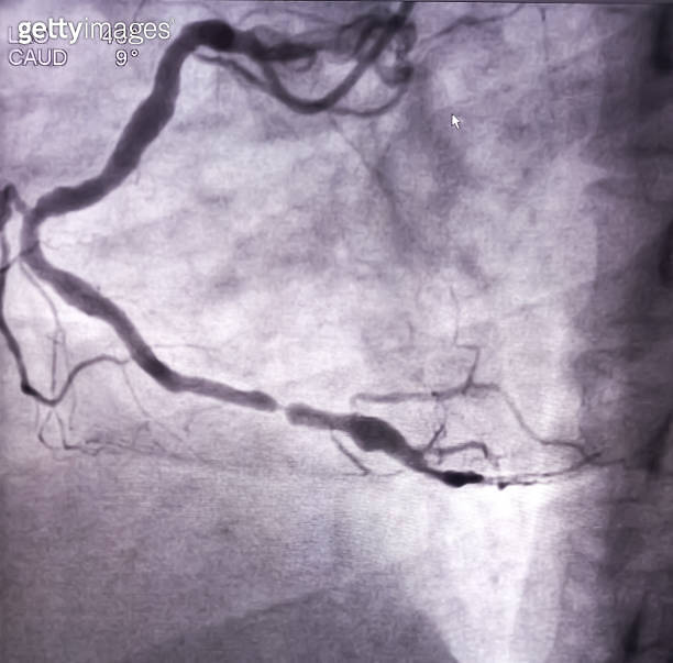 Coronary angiogram of right coronary artery during cardiac ...