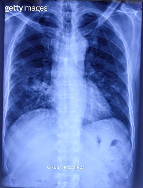 CXR (X-ray of chest) PA view. Pulmonary tuberculosis with pneumonia ...