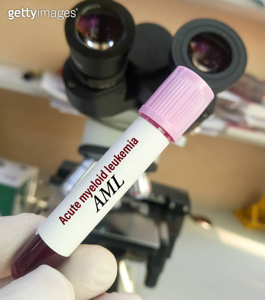 Blood sample for Acute myeloid leukemia (AML) test. It is a rare cancer ...