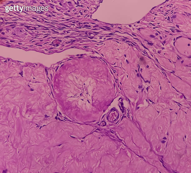 Uterus with adnexa (biopsy): Cervix show chronic inflamatory cells ...