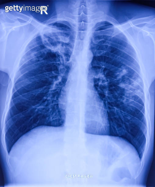 CXR (X-ray of chest) PA view. Non homogeneous opacities are noted in ...
