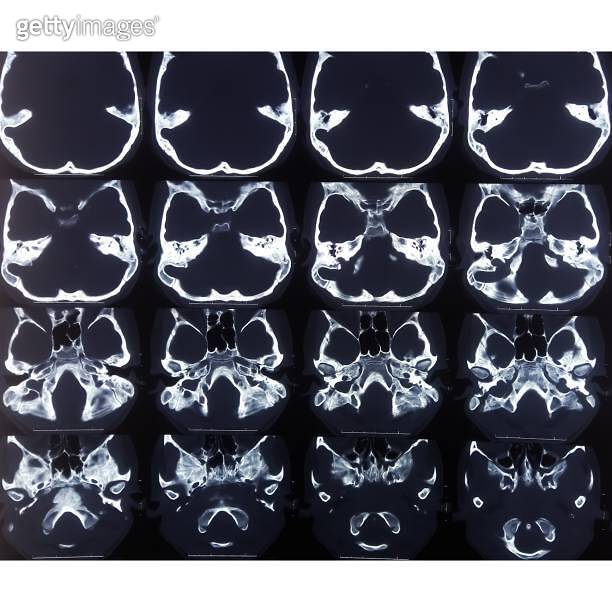 CT scan of the temporal bones showing soft tissue density lesion at ...