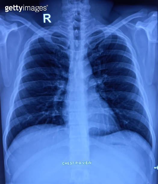 CXR (X-ray of chest) PA view. Non homogeneous opacities are noted in ...