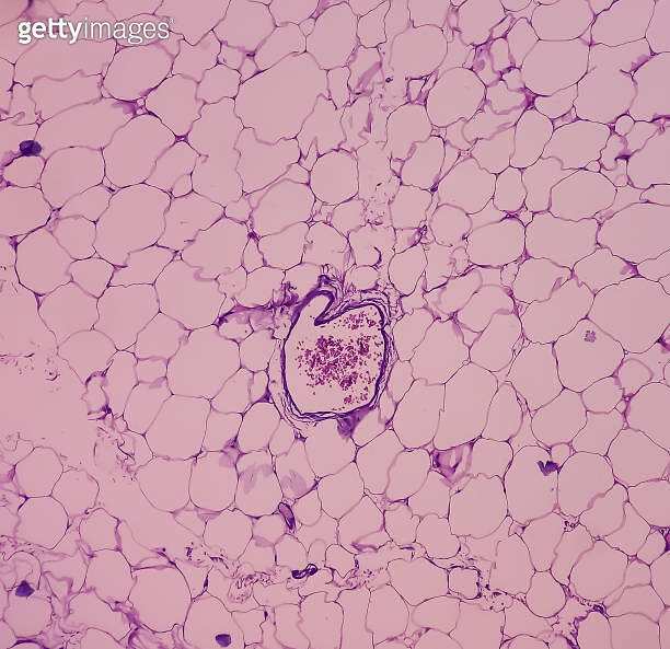 Lipoma on loin, benign growth of fatty tissue, benign neoplasm ...
