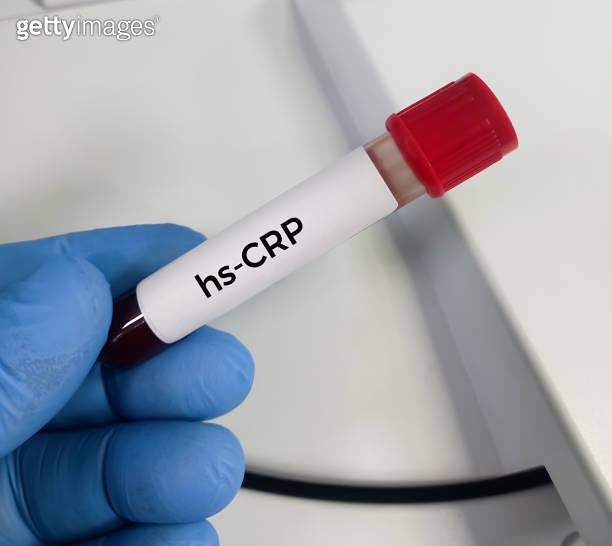 Blood sample for hs-CRP (high sensitivity - CRP) test, for the ...