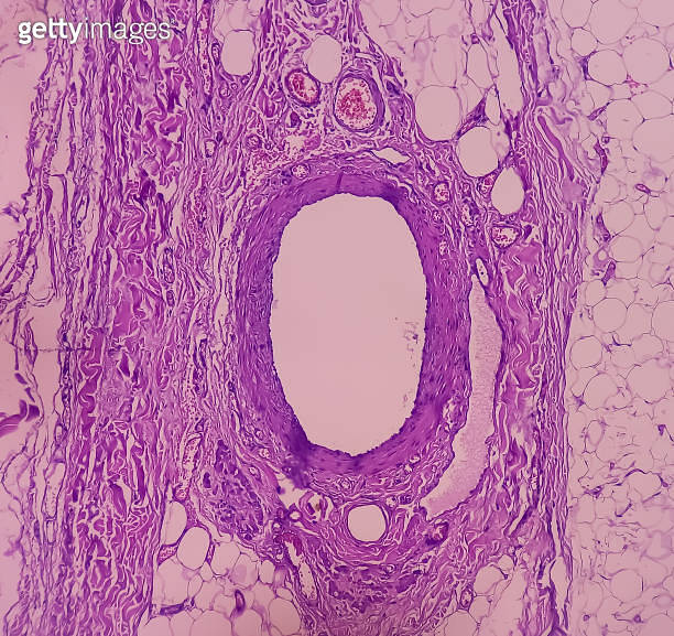 Lipoma on loin, benign growth of fatty tissue, benign neoplasm ...