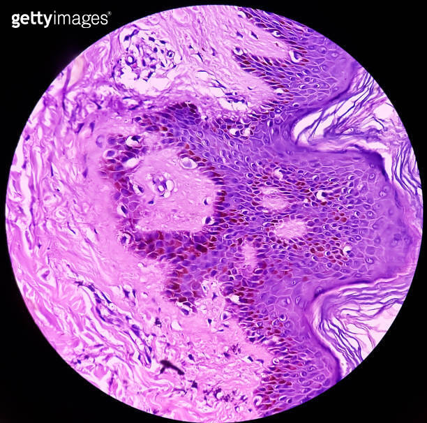 Lipoma On Loin Benign Growth Of Fatty Tissue Benign Neoplasm