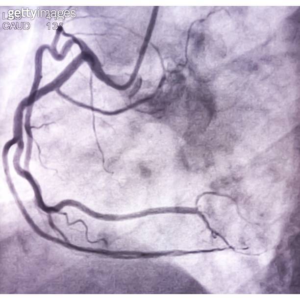 Coronary angiogram of right coronary artery during cardiac ...