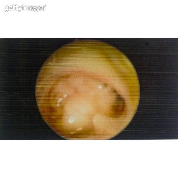 Ear endoscopy. Chronic suppurative otitis media (CSOM). Subtotal ...