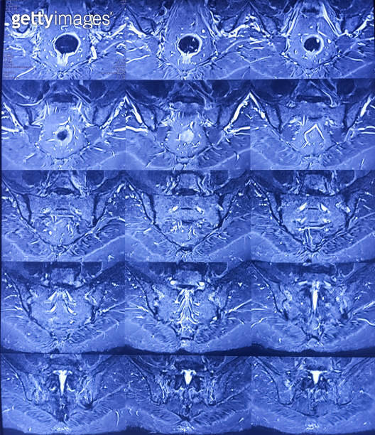 MRI of SI (Sacroiliac) joint. Screening of lumbar spine: Lumbar ...