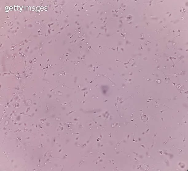 Normozoospermia analyzed by microscope. Semen analysis normal sperm and ...