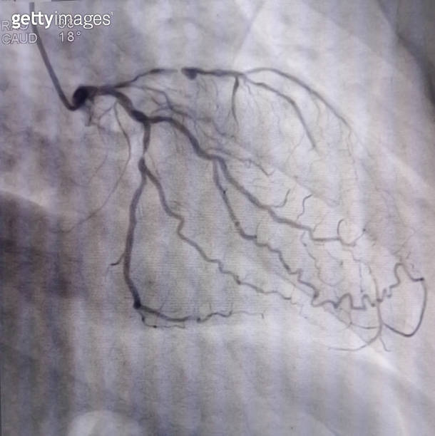 Coronary angiogram of left coronary artery during cardiac ...
