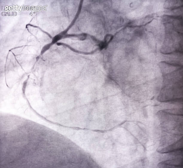 Coronary angiogram of right coronary artery during cardiac ...