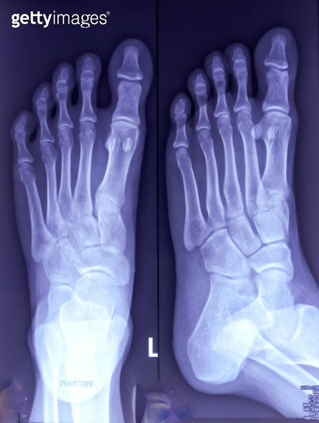 X-ray of foot both view. foot xray. ankle joint. (1898289795) 일러스트, 무료 ...