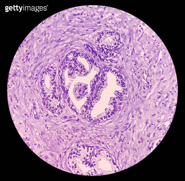 Prostatic chips (TURP): Adenocarcinoma. Sections show core of prostatic ...