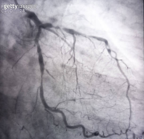 Coronary angiogram of left coronary artery during cardiac ...