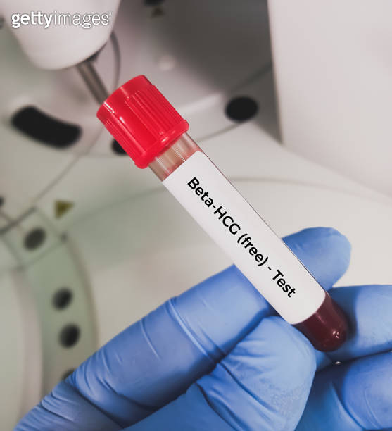 Blood sample for Free Beta hCG hormone test, health and medical concept ...