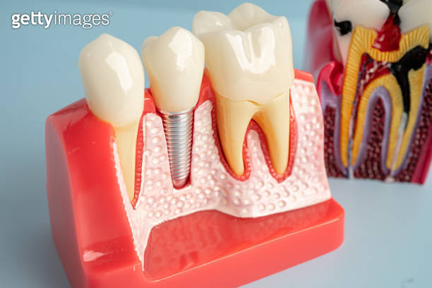 Dental implant, artificial tooth roots into jaw, root canal of dental ...
