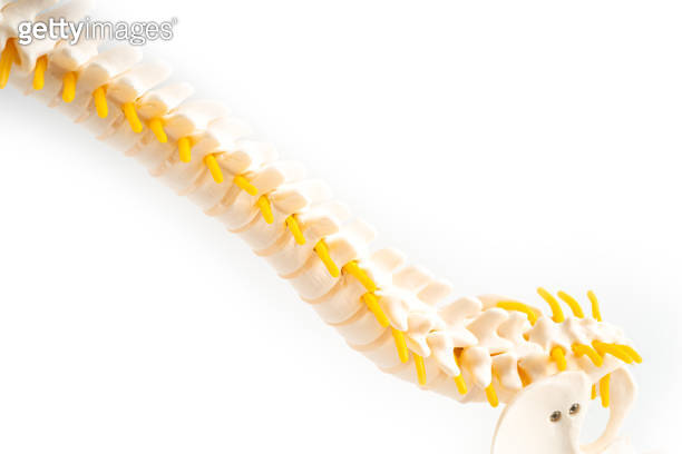 Lumbar spine displaced herniated disc fragment, spinal nerve and bone ...