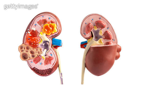 Kidney disease, Chronic kidney disease ckd, model for study isolated on ...
