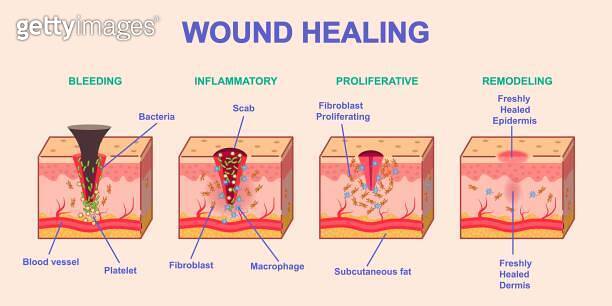 Wound healing process vector illustration (2128406198) 일러스트, 무료 일러스트 ...