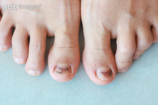 Subungual Hematoma on toenail are injuries of wearing shoes that are ...