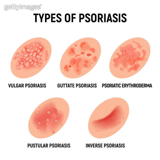 Psoriasis rash vector skin hand infection background. Psoriasis ...