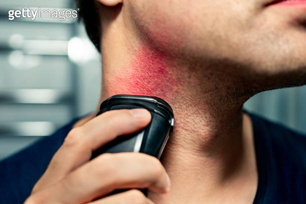 Razor burn, shave rash and skin irritation. Electric shaver. Ingrown ...