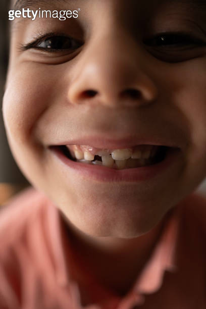 Close-up mouth child has lost one milk teeth. Replacement of permanent ...