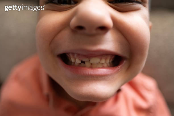 Close-up mouth child has lost one milk teeth. Replacement of permanent ...