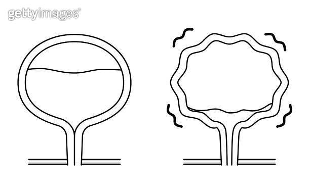 Medical illustration of overactive bladder, normal bladder vs. 이미지 ...