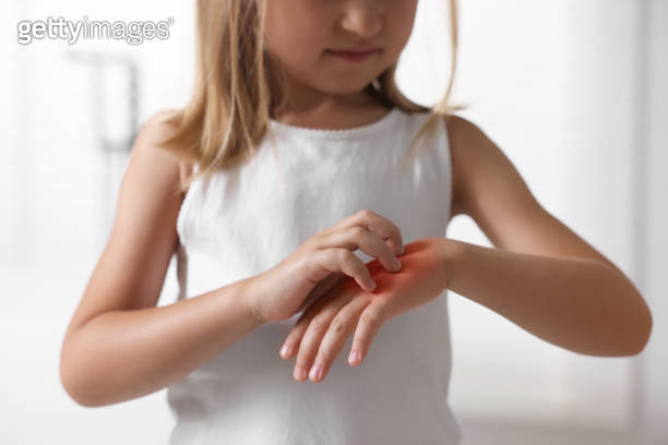 Suffering from allergy. Little girl scratching her hand indoors ...