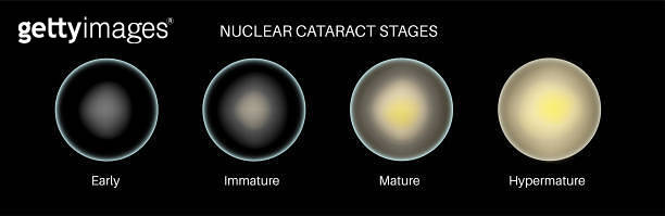 Cataract eye disease 이미지 (2164871932) - 게티이미지뱅크
