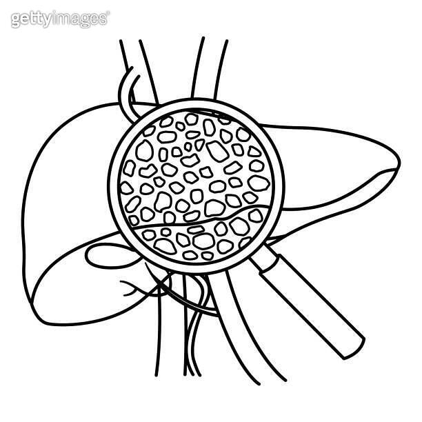 Liver Disease for Coloring Page. Cirrhosis of the Liver under a ...