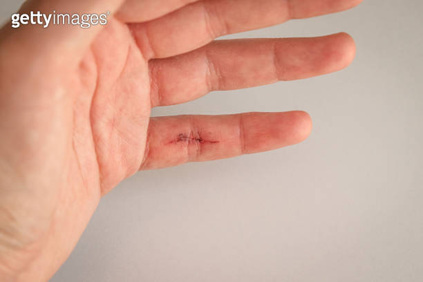 Scar on a woman's finger. The wound damage on epidermis, outermost ...