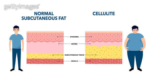 Cellulite concept, excess fat in human body. Overweight and increase ...