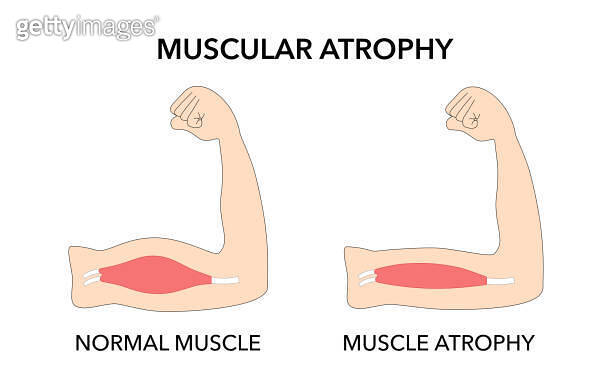Muscular atrophy compared to healthy outline diagram. Weakness abnormal ...
