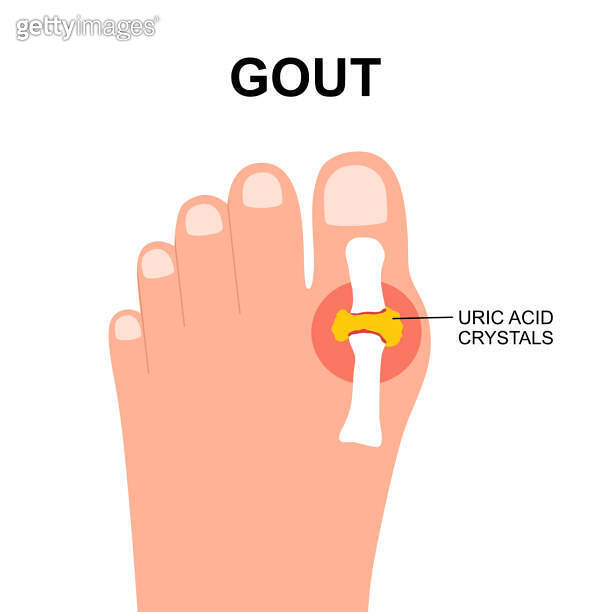 Gout arthritis with Uric acid crystals. Human foot in flat design. 이미지 ...