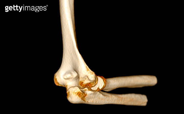 A 3D CT scan of the elbow joint showing normal bone structure and ...