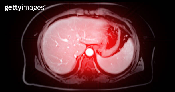 MRI of the upper abdomen is a non-invasive imaging technique providing ...