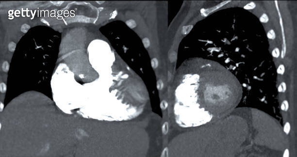 A CTA pulmonary artery reveals a detailed view of the lung blood ...