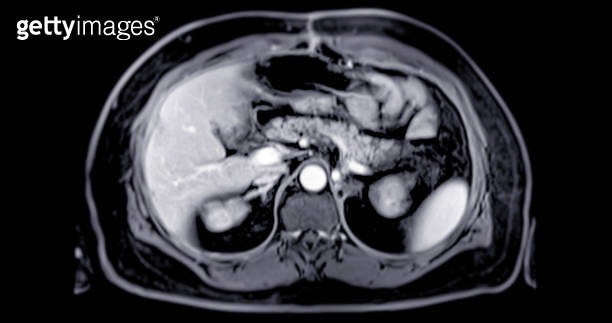 MRI of the upper abdomen is a non-invasive imaging technique providing ...