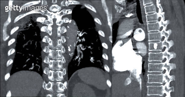 A CTA pulmonary artery reveals a detailed view of the lung blood ...