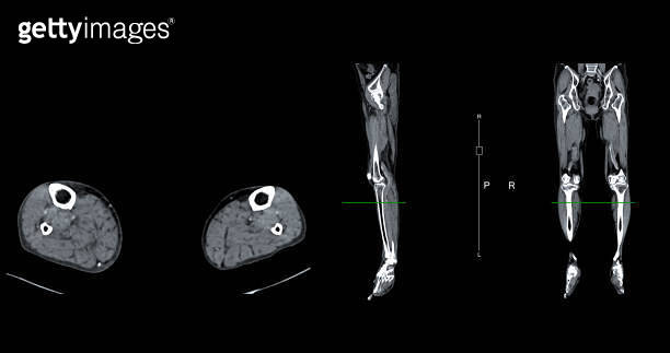 A CT venogram of the leg is a non-invasive imaging procedure offering ...
