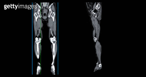 A CT venogram of the leg is a non-invasive imaging procedure offering ...