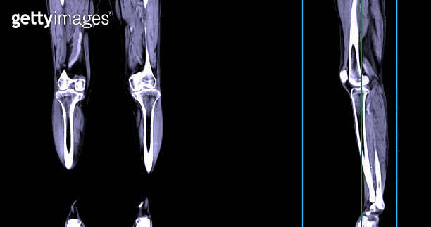 A CT venogram of the leg is a non-invasive imaging procedure offering ...