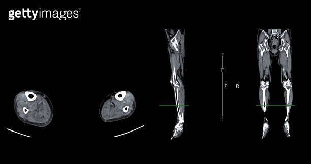 A CT venogram of the leg is a non-invasive imaging procedure offering ...