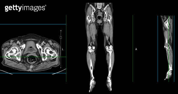 A CT venogram of the leg is a non-invasive imaging procedure offering ...