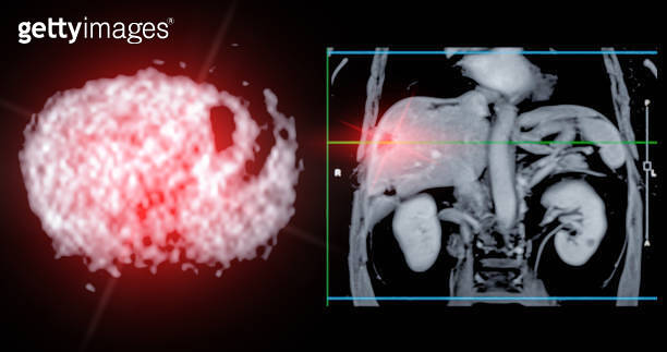 PET MRI of the liver in liver cancer provides precise imaging, aiding ...